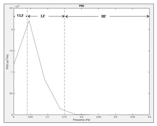 Automatic Sleep Disorders Classification Using Ensemble of Bagged Tree ...
