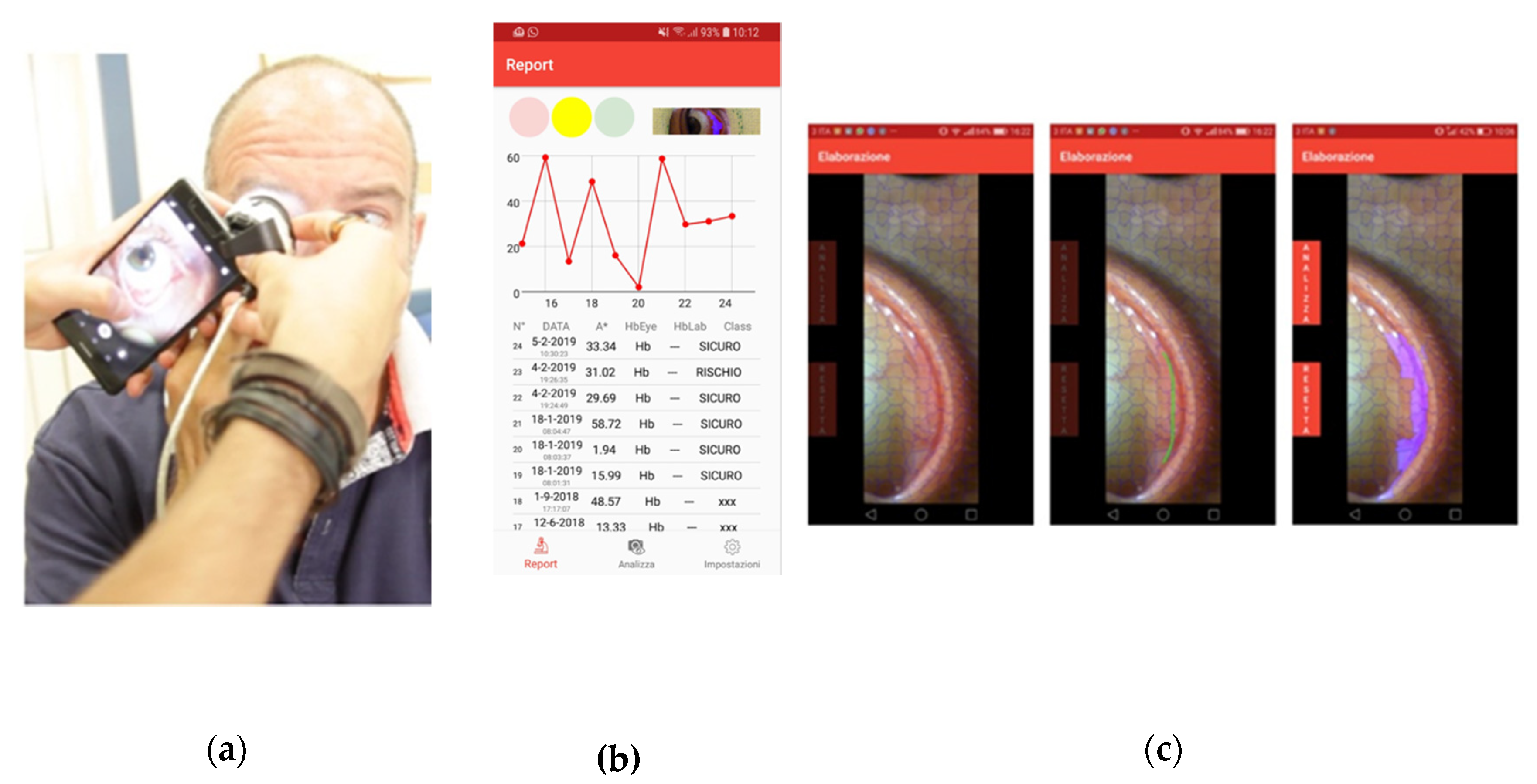 Estimate of Anemia with New Non-Invasive Systems—A Moment of Reflection
