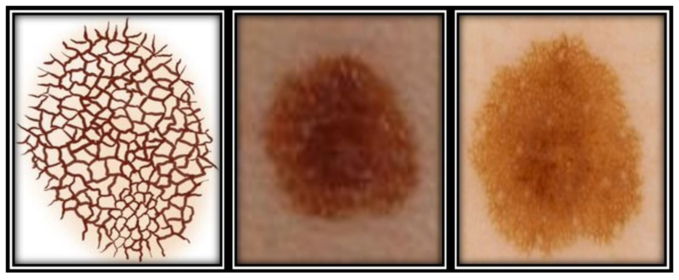 Staging Melanocytic Skin Neoplasms Using High-Level Pixel-Based Features
