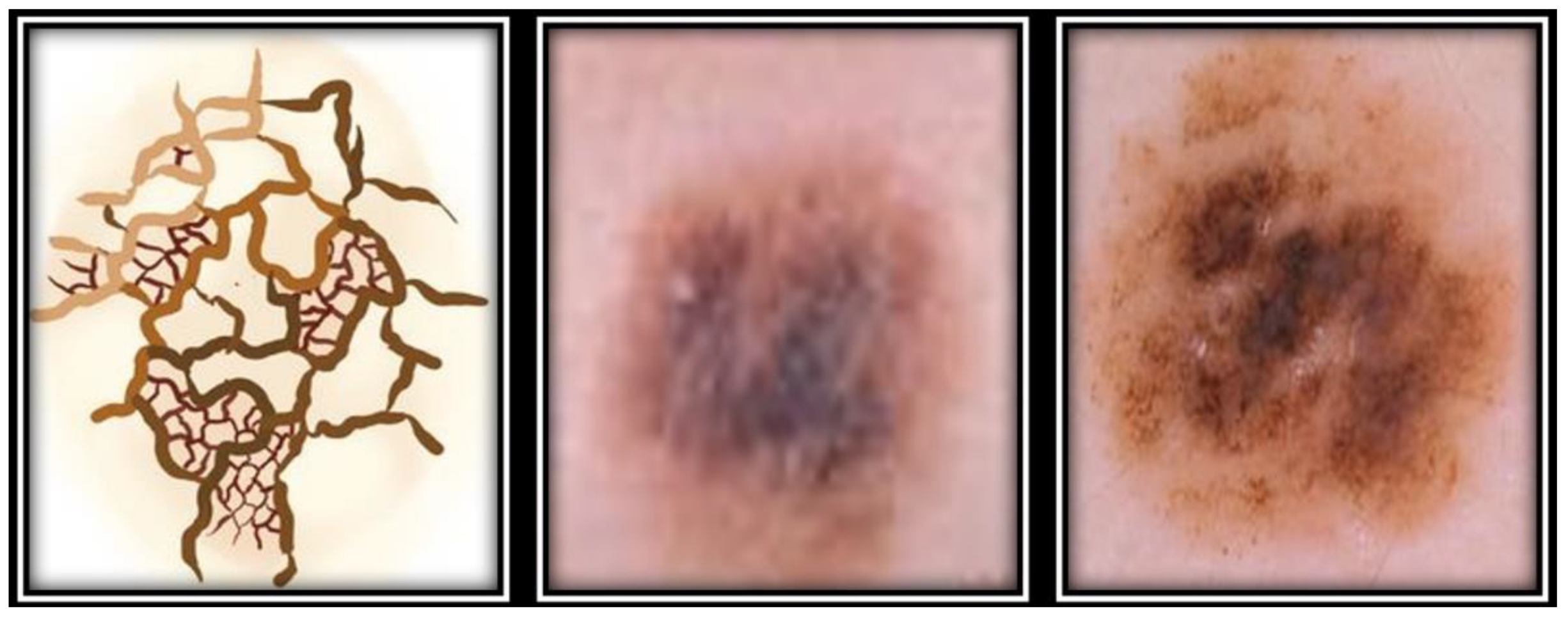 Staging Melanocytic Skin Neoplasms Using High-Level Pixel-Based Features