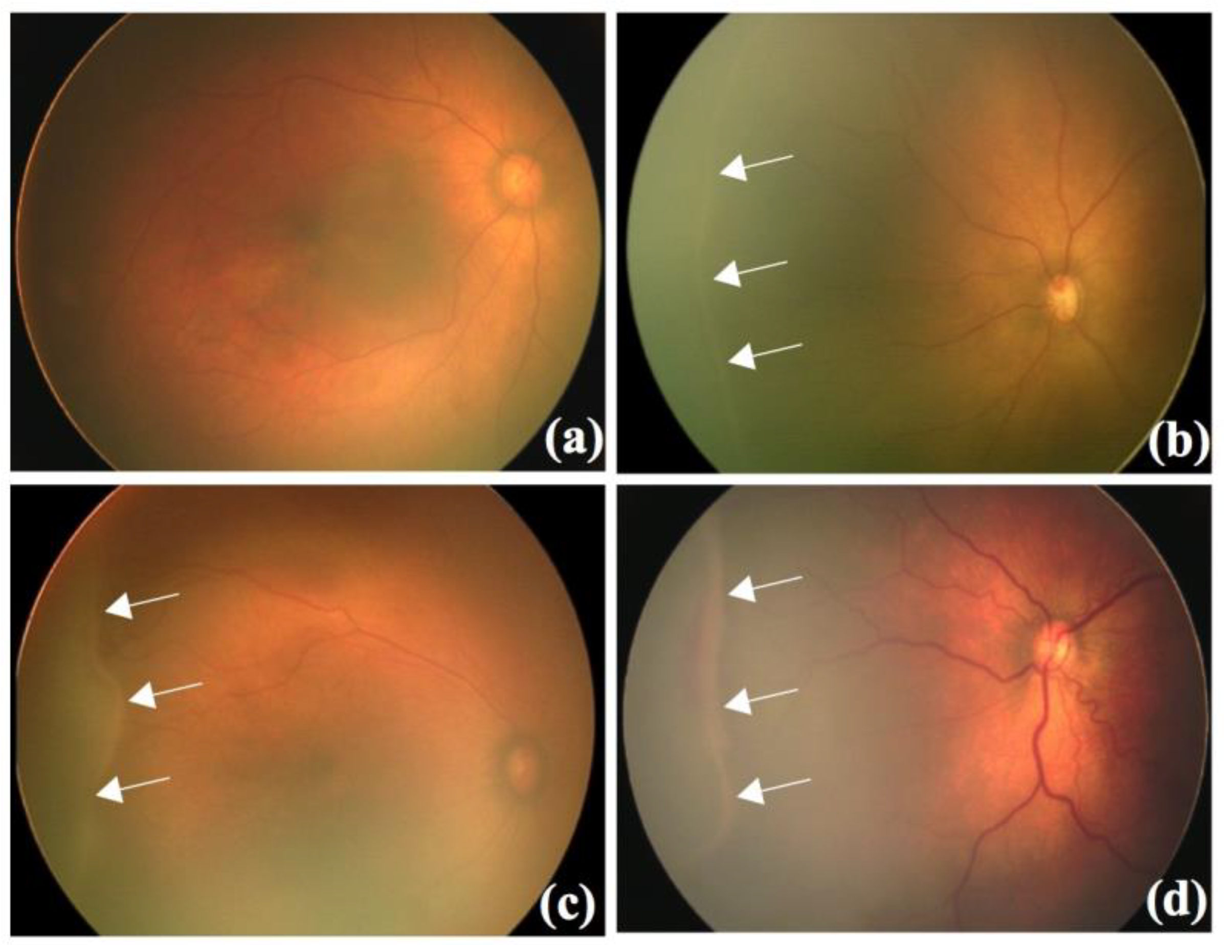 Retinopathy Of Prematurity