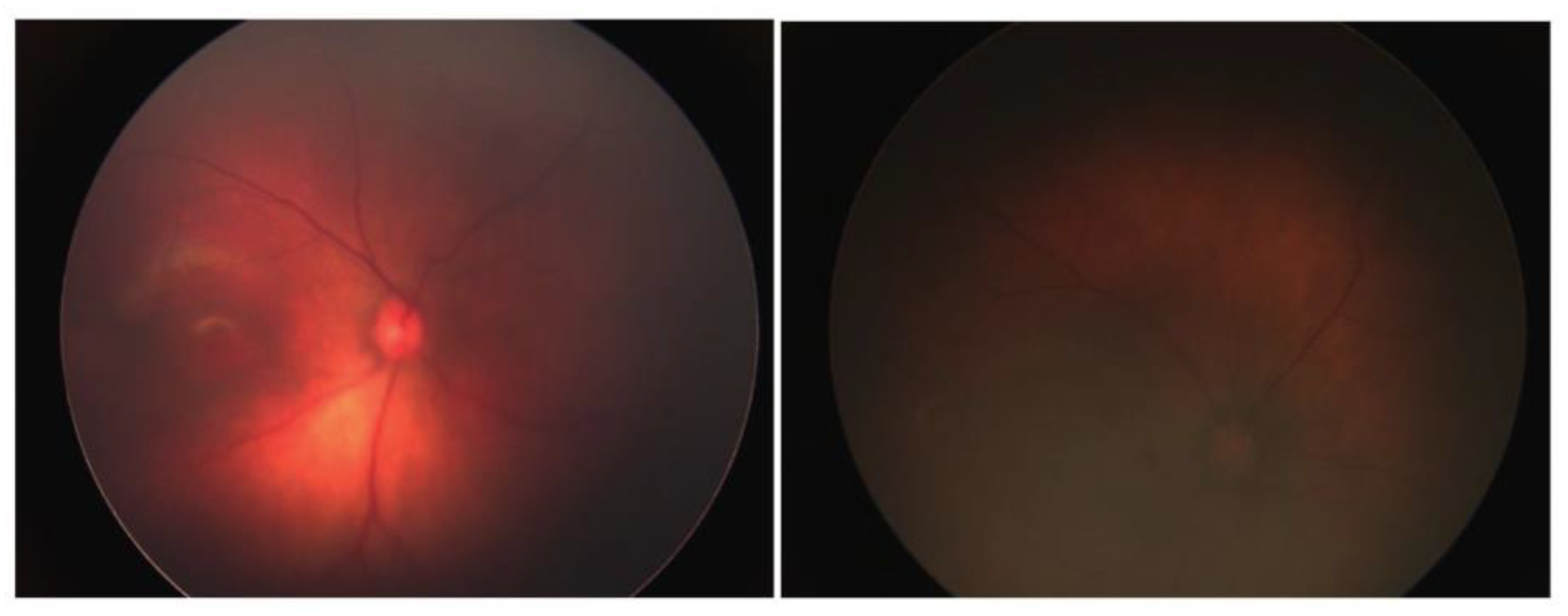 Deep Learning Models for Automated Diagnosis of Retinopathy of ...