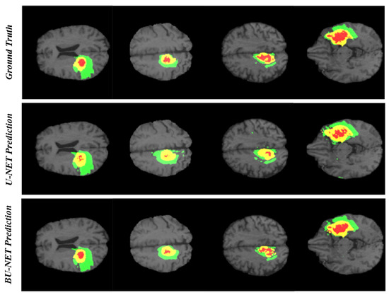 BU-Net: Brain Tumor Segmentation Using Modified U-Net Architecture
