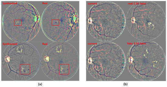 Future Image Synthesis for Diabetic Retinopathy Based on the Lesion ...