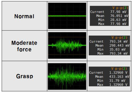 Development of Miniaturized Wearable Wristband Type Surface EMG ...