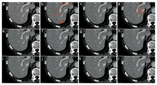 Effects of Enhancement on Deep Learning Based Hepatic Vessel Segmentation