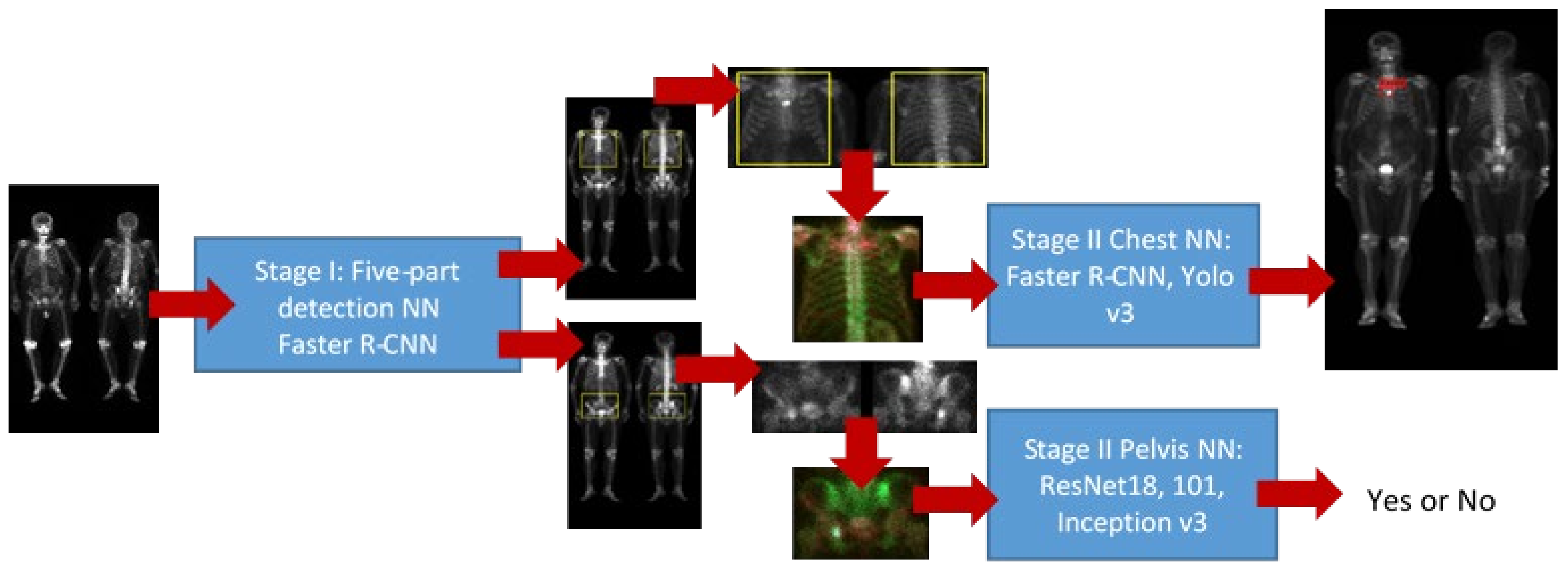 Bone Metastasis Detection in the Chest and Pelvis from a Whole-Body Bone Scan Using Deep ...