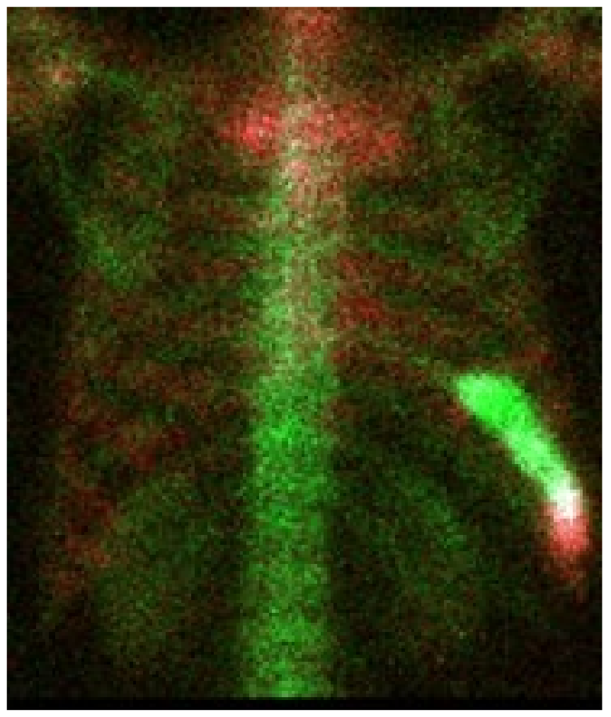 Bone Metastasis Detection in the Chest and Pelvis from a Whole-Body ...