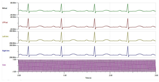 An IoT Assisted Real-Time High CMRR Wireless Ambulatory ECG Monitoring ...