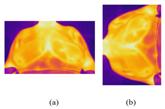 Self-Detection of Early Breast Cancer Application with Infrared Camera ...
