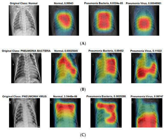 Electronics | Free Full-Text | PneumoniaNet: Automated Detection and ...