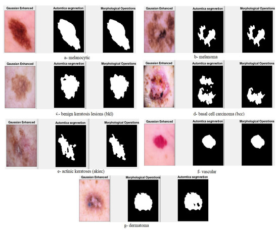 Deep Learning and Machine Learning Techniques of Diagnosis Dermoscopy ...