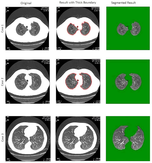 Efficient Pre-Processing and Segmentation for Lung Cancer Detection ...