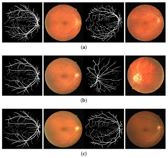 A Two-Stage GAN for High-Resolution Retinal Image Generation and ...