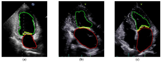 Electronics | Free Full-Text | Segmentation of Echocardiography Based on Deep Learning Model