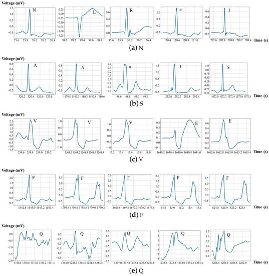 Accurate ECG Classification Based on Spiking Neural Network and ...
