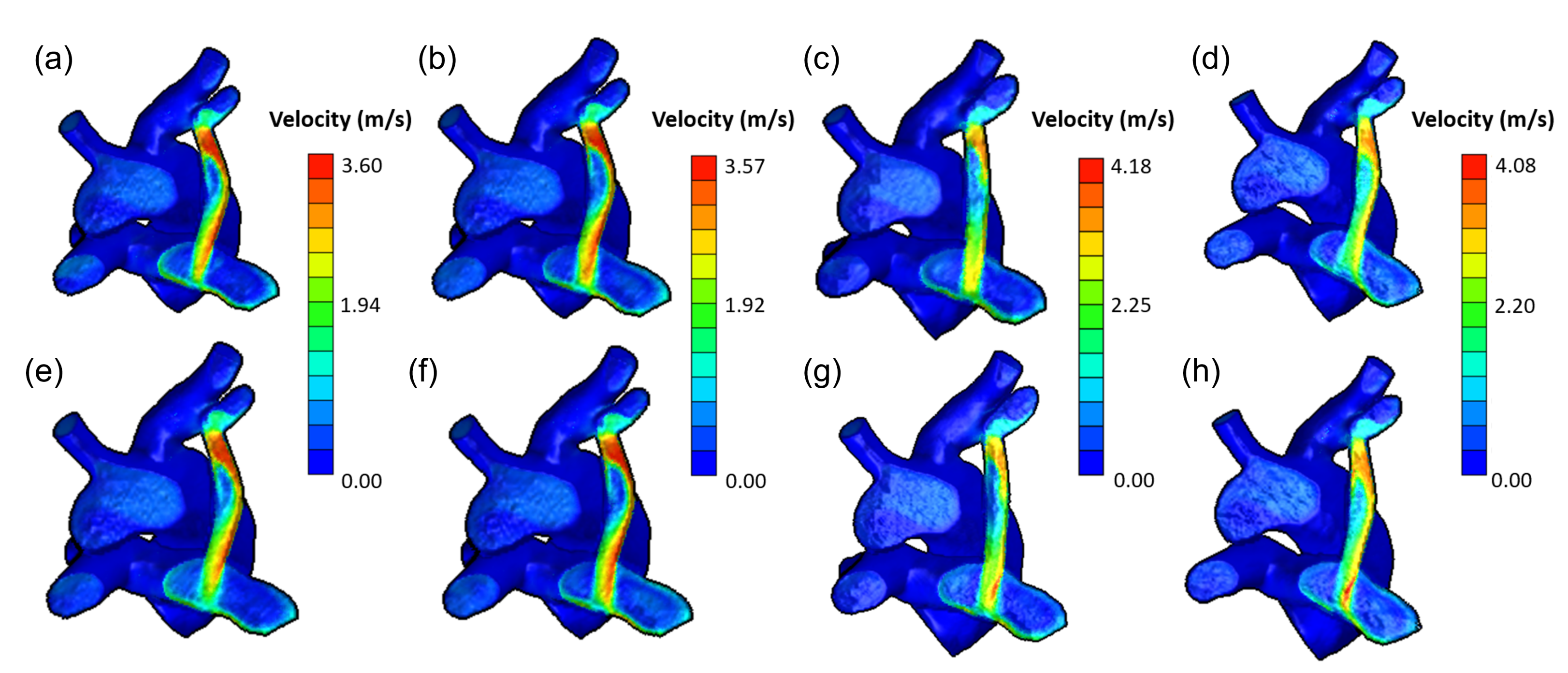 Blalock Taussig Shunt