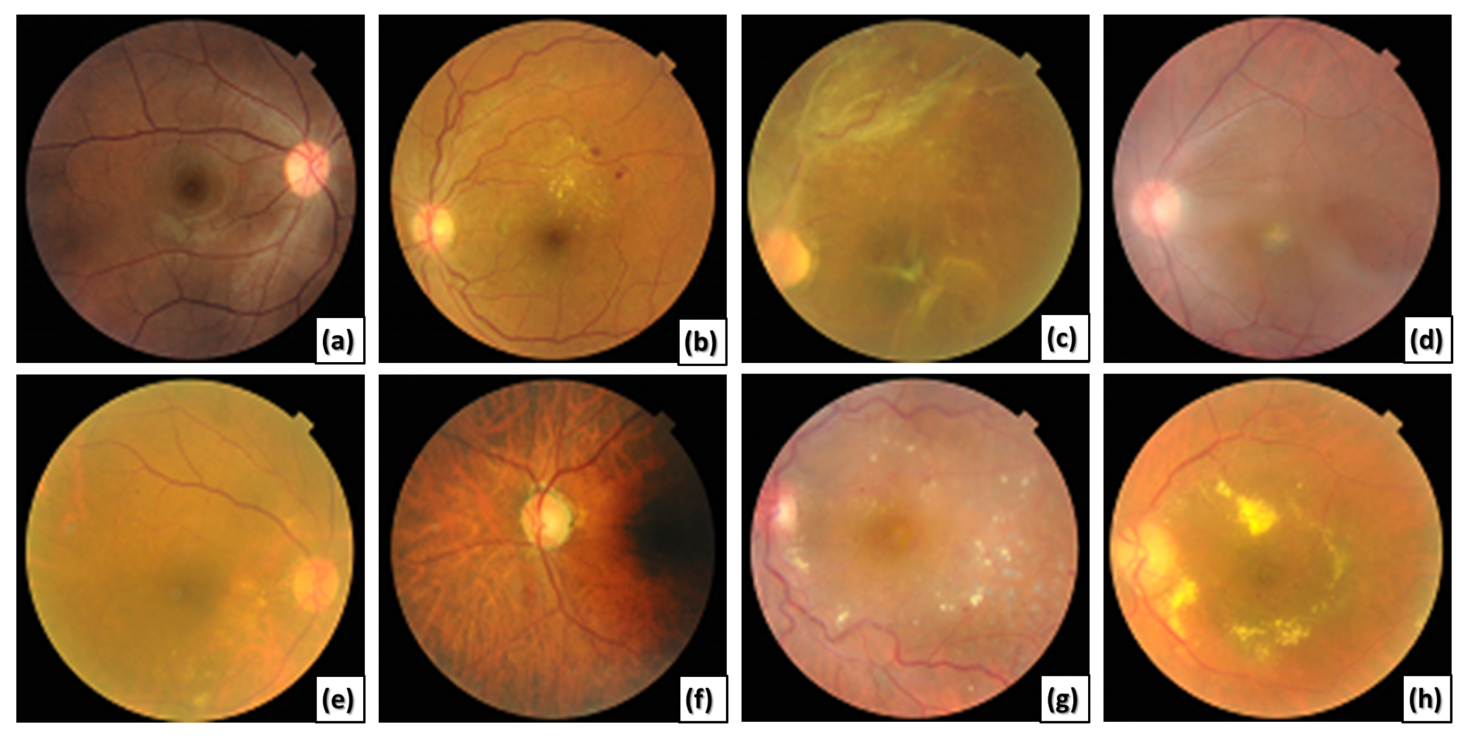 Electronics | Free Full-Text | Multiple Ocular Disease Diagnosis Using Fundus Images Based on ...