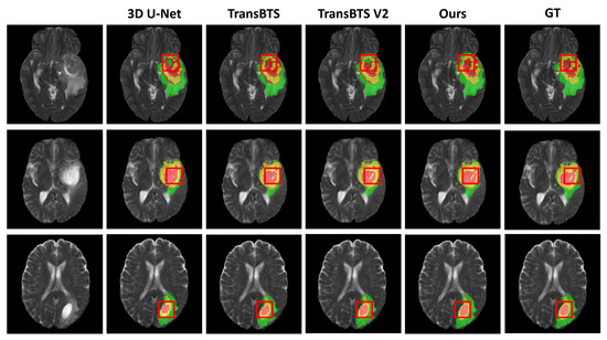 CSU-Net: A CNN-Transformer Parallel Network for Multimodal Brain Tumour Segmentation
