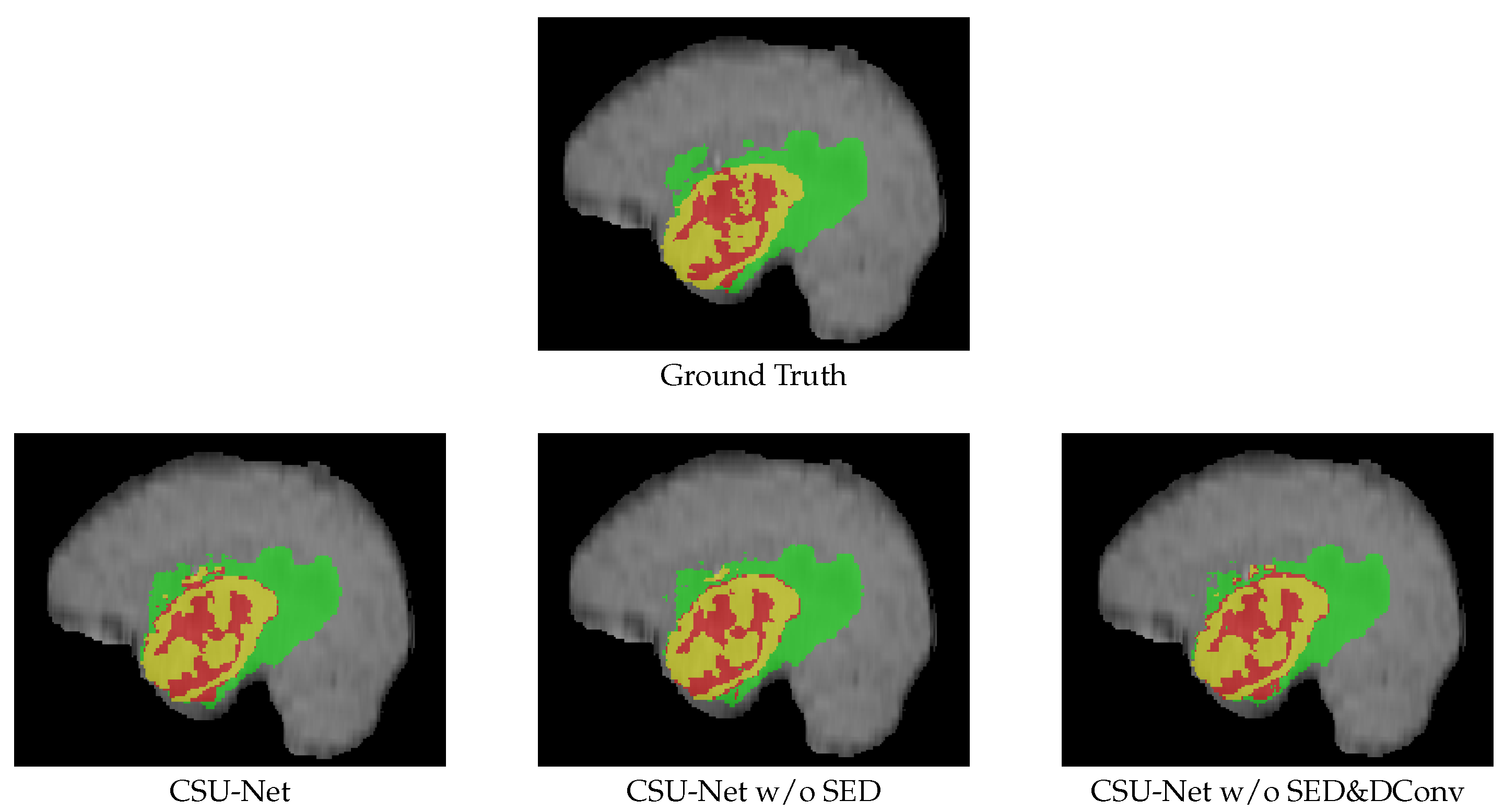 Csu Net A Cnn Transformer Parallel Network For Multimodal Brain Tumour