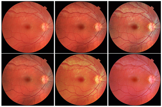 Real-Time CLAHE Algorithm Implementation in SoC FPGA Device for 4K UHD Video Stream