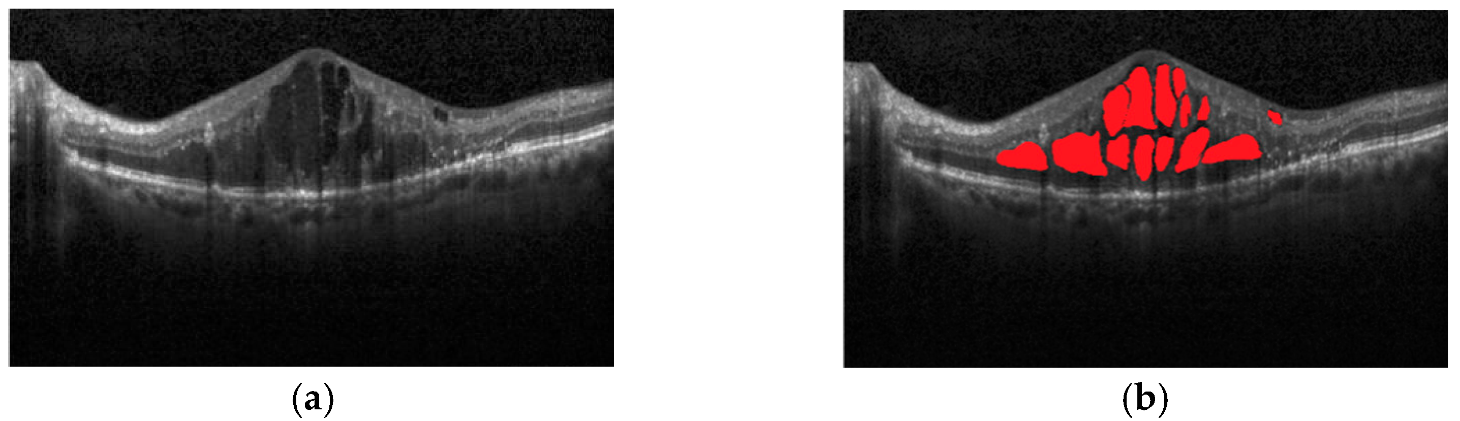 Electronics | Free Full-Text | Research on Semantic Segmentation Method of Macular Edema in ...