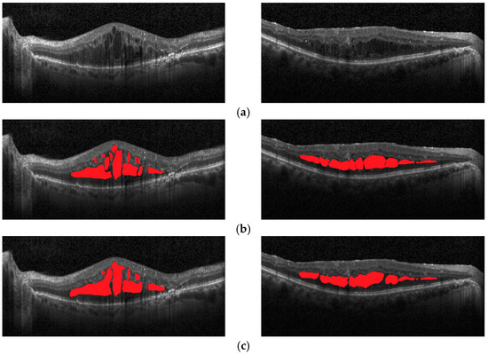 Electronics | Free Full-Text | Research on Semantic Segmentation Method of Macular Edema in ...