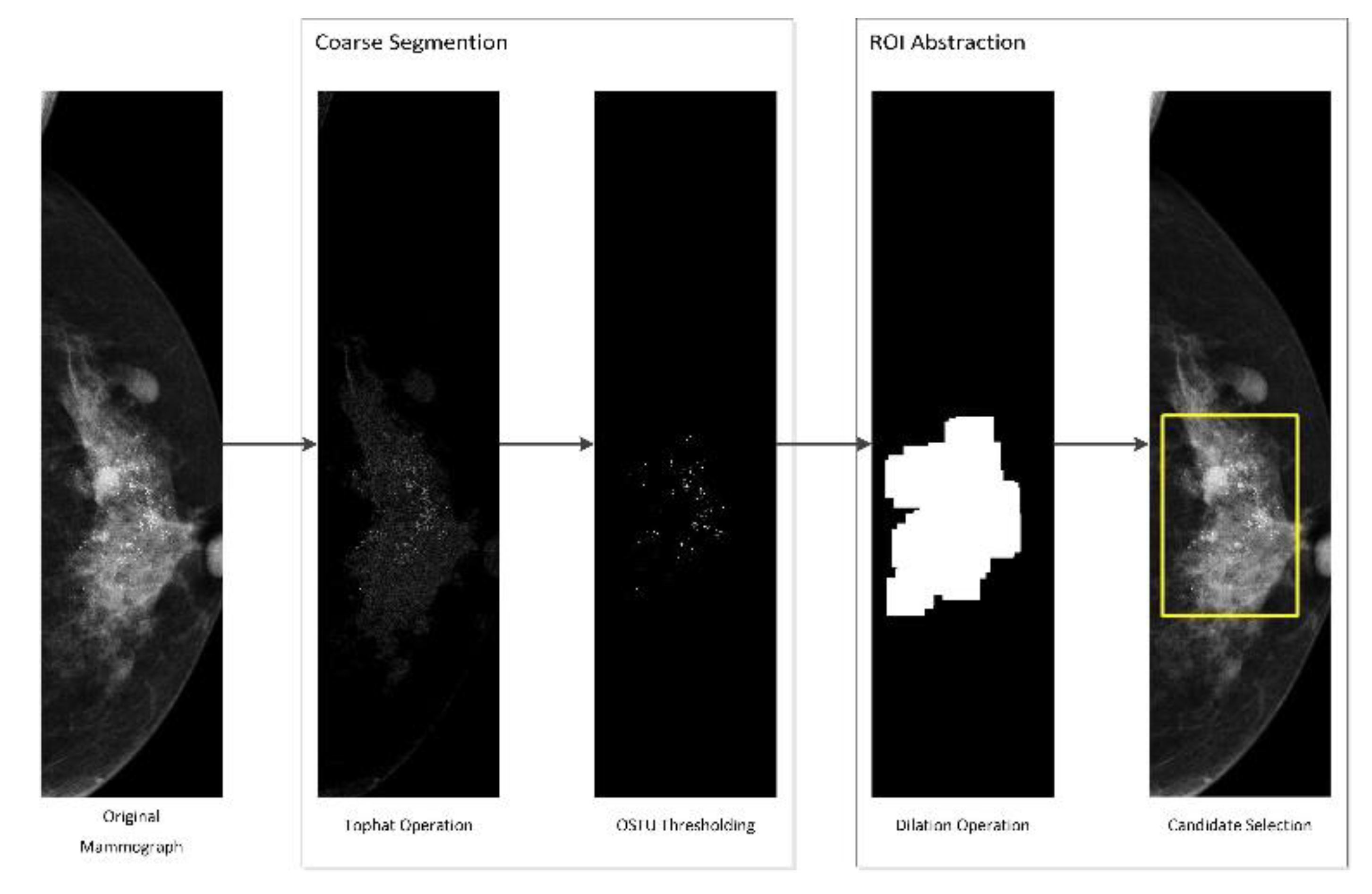 Mammographic Classification of Breast Cancer Microcalcifications through Extreme Gradient Boosting