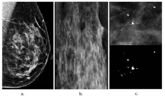 Mammographic Classification of Breast Cancer Microcalcifications through Extreme Gradient Boosting