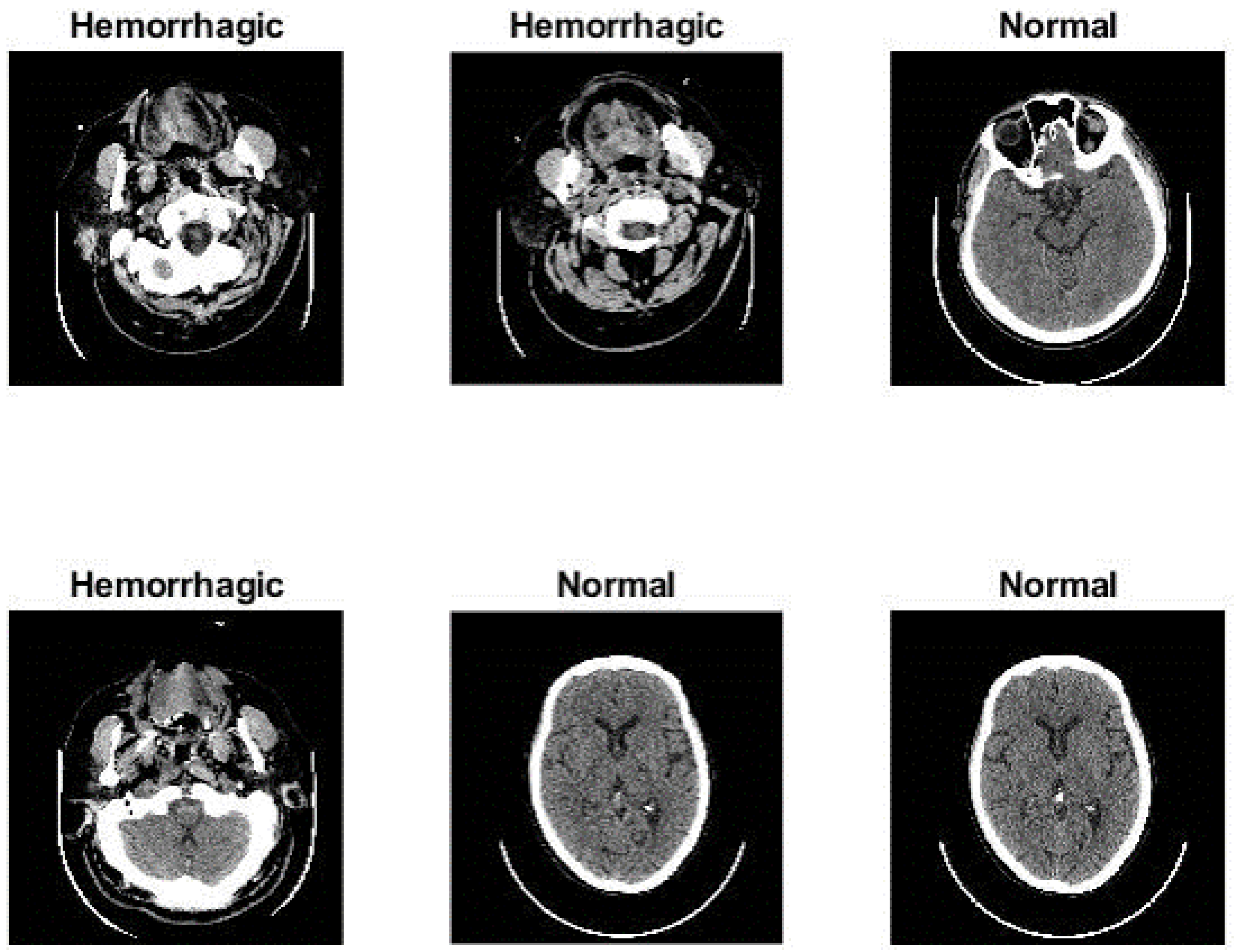 Multi-Method Diagnosis of CT Images for Rapid Detection of Intracranial ...
