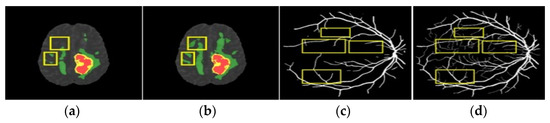 LSW-Net: A Learning Scattering Wavelet Network for Brain Tumor and ...