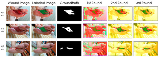 A Granulation Tissue Detection Model to Track Chronic Wound Healing in ...