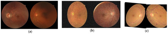 Detection of Diabetic Retinopathy in Retinal Fundus Images Using CNN ...