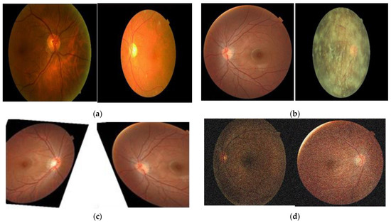 Detection of Diabetic Retinopathy in Retinal Fundus Images Using CNN Classification Models