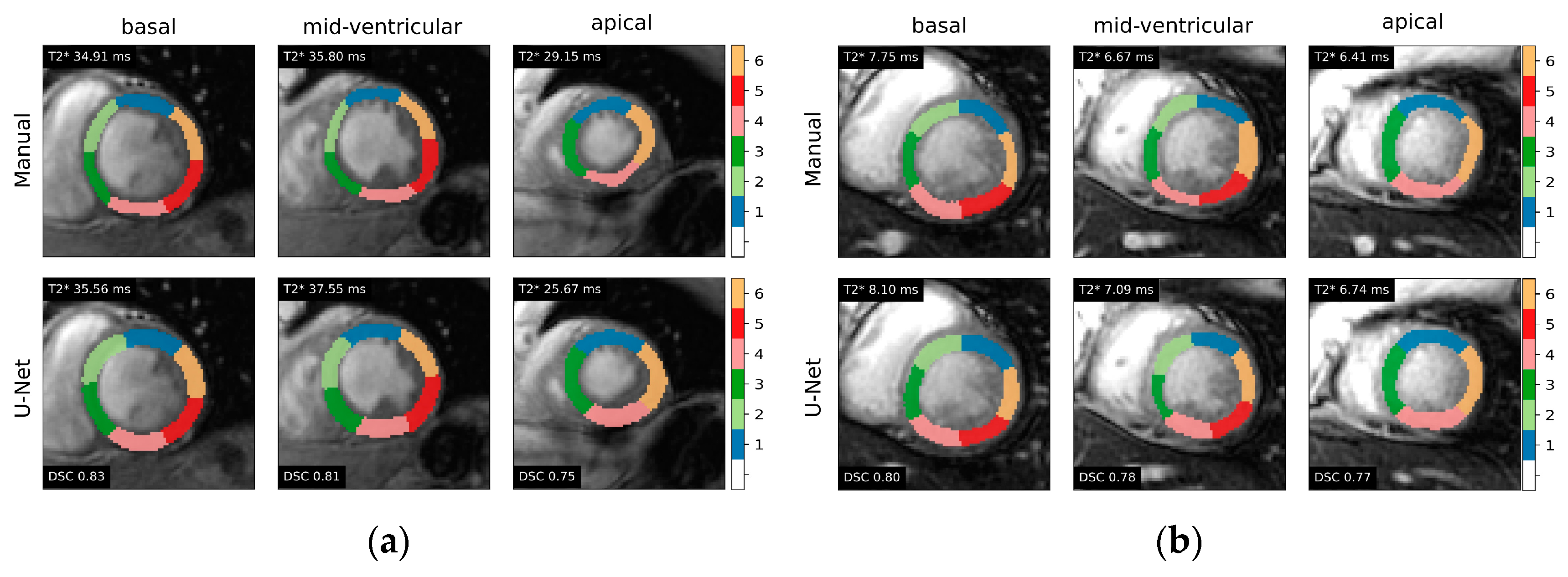 Fully Automated Regional Analysis of Myocardial T2* Values for Iron Quantification Using Deep ...