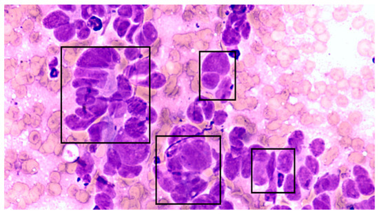 Intelligent Hybrid Deep Learning Model for Breast Cancer Detection