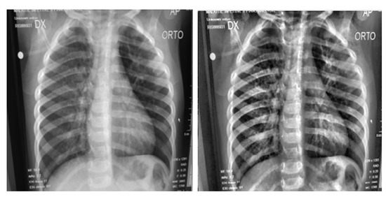 Hybrid CLAHE-CNN Deep Neural Networks for Classifying Lung Diseases ...