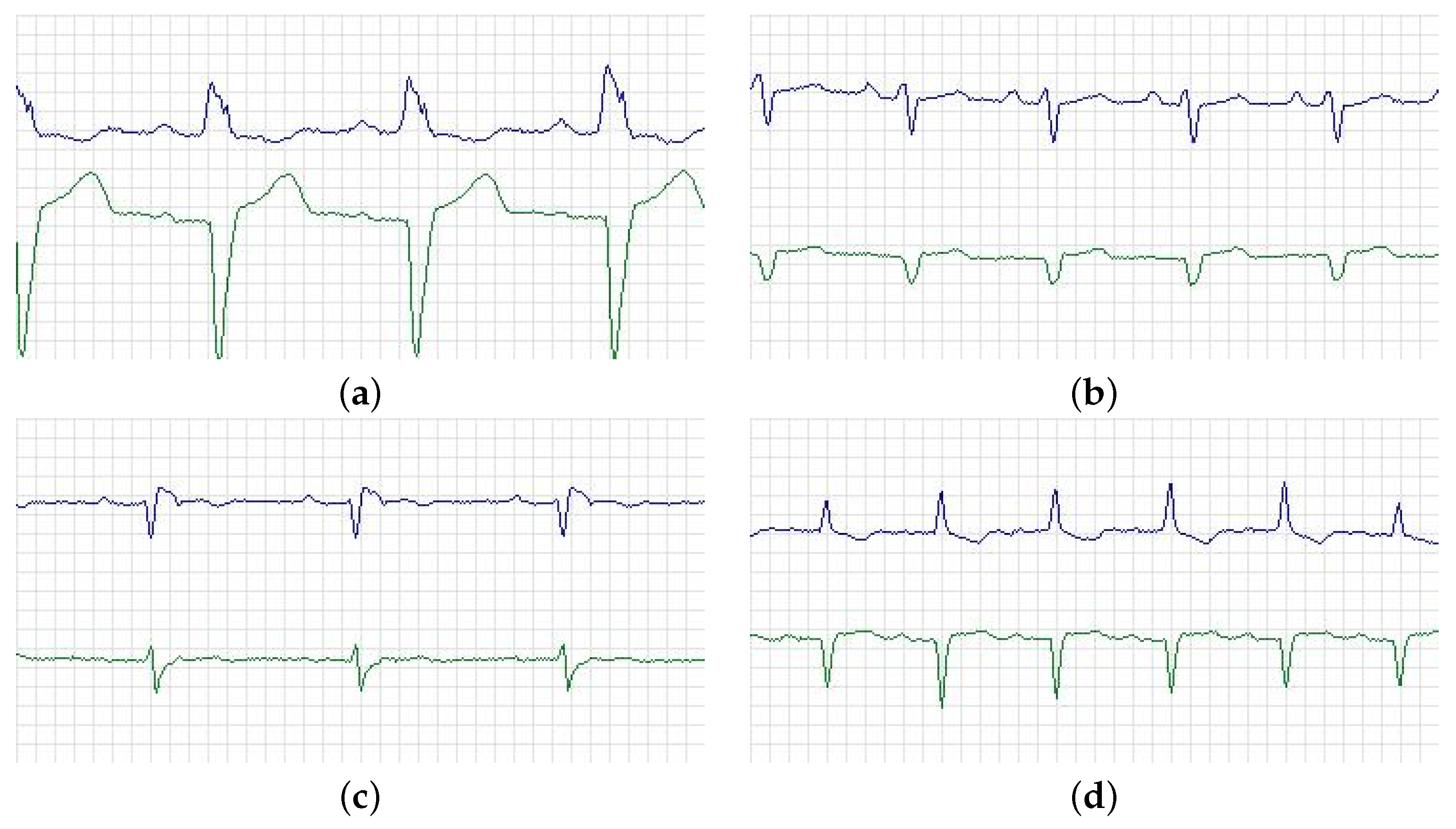 Arrhythmia Classification and Diagnosis Based on ECG Signal: A Multi-Domain Collaborative ...