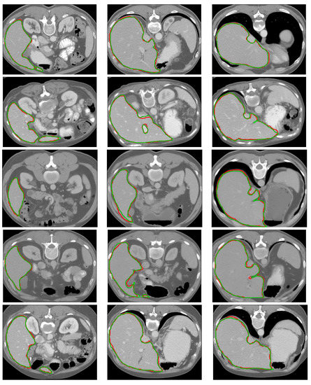 Fast 3D Liver Segmentation Using a Trained Deep Chan-Vese Model