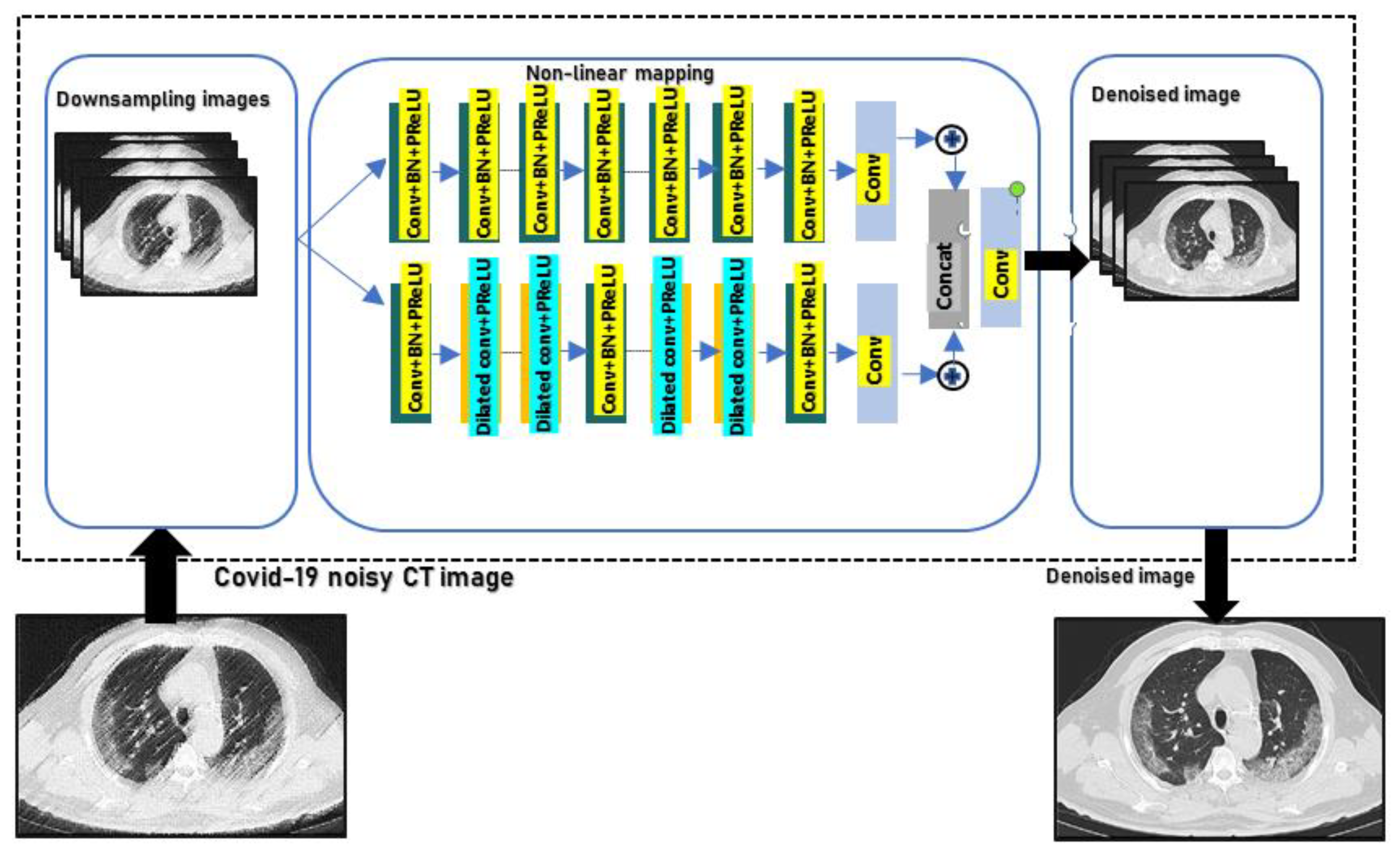 Low-Dose COVID-19 CT Image Denoising Using Batch Normalization and Convolution Neural Network