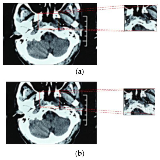 Low-Dose COVID-19 CT Image Denoising Using Batch Normalization and Convolution Neural Network