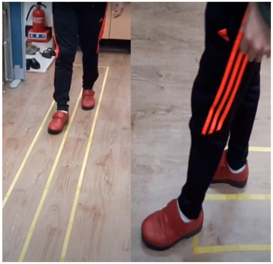 Artificial Neural Network-Based Abnormal Gait Pattern Classification ...
