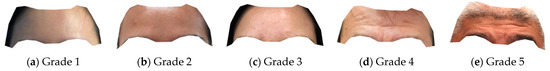Classifying Conditions of Speckle and Wrinkle on the Human Face: A Deep ...