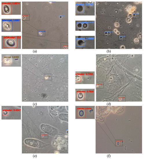 An Accurate Urine Red Blood Cell Detection Method Based on Multi-Focus ...