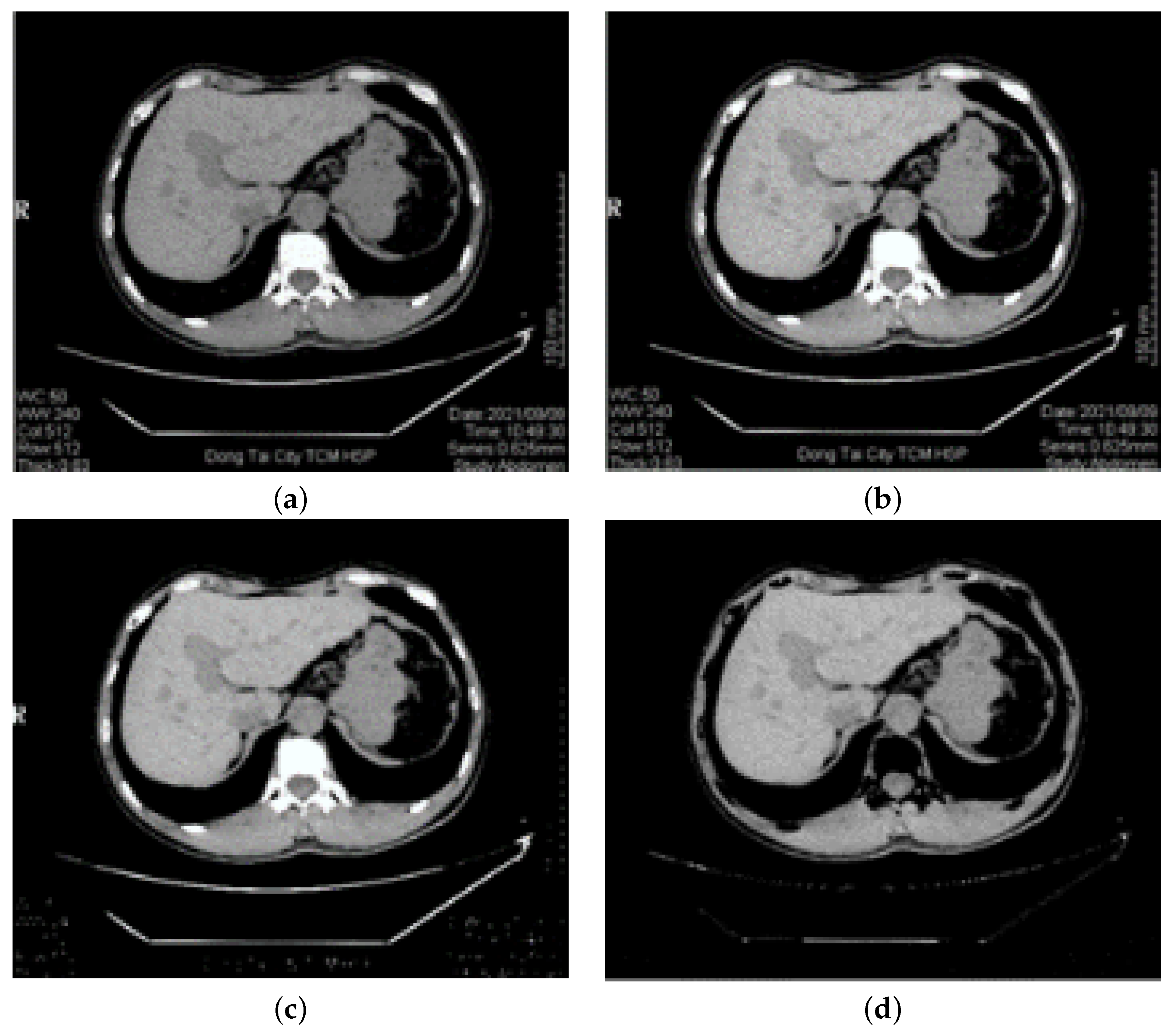 An Efficient Framework for Accurate Liver Segmentation in Abdominal CT ...