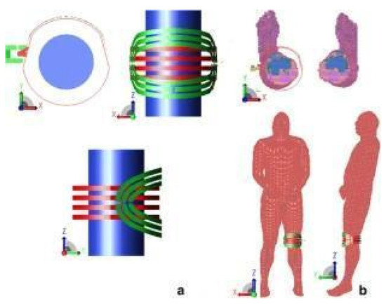 Radiofrequency Coils for Low-Field (0.18–0.55 T) Magnetic Resonance ...