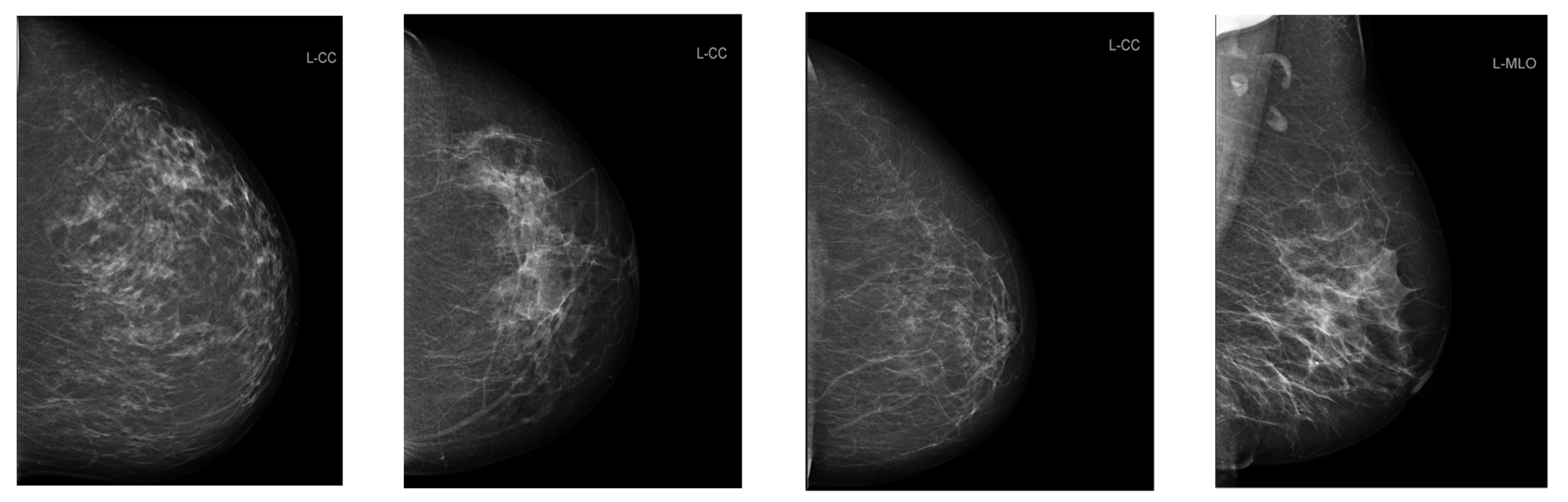 Detecting Breast Arterial Calcifications in Mammograms with Transfer ...