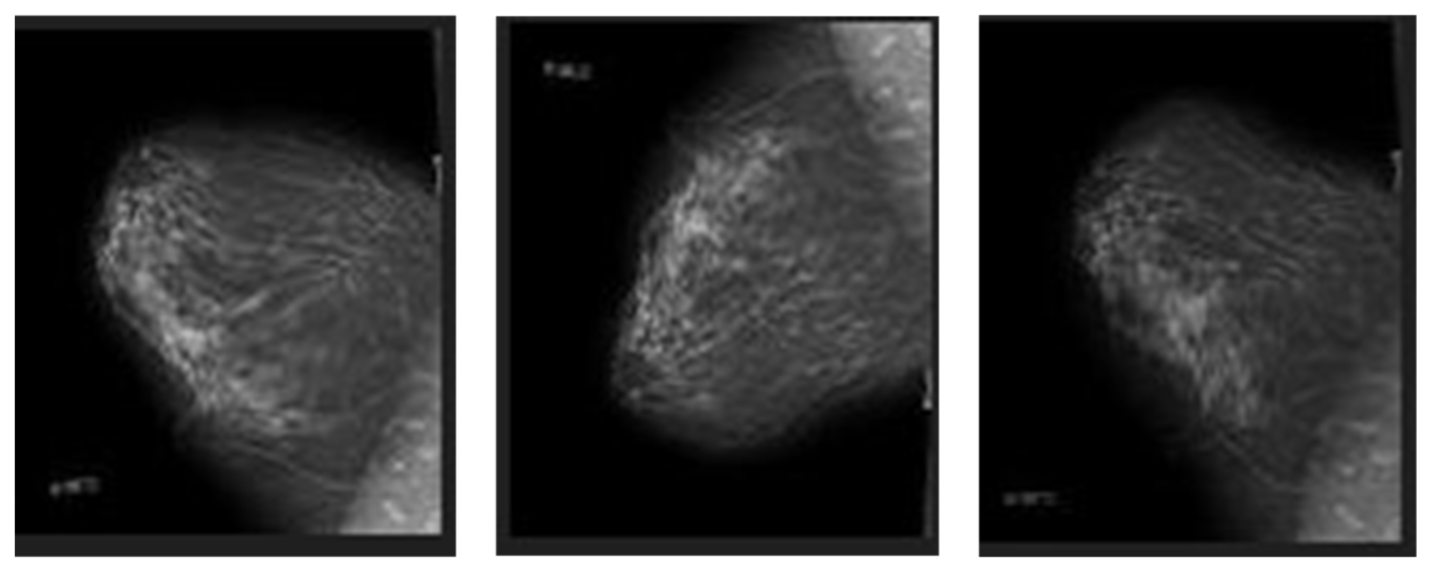 Detecting Breast Arterial Calcifications in Mammograms with Transfer Learning