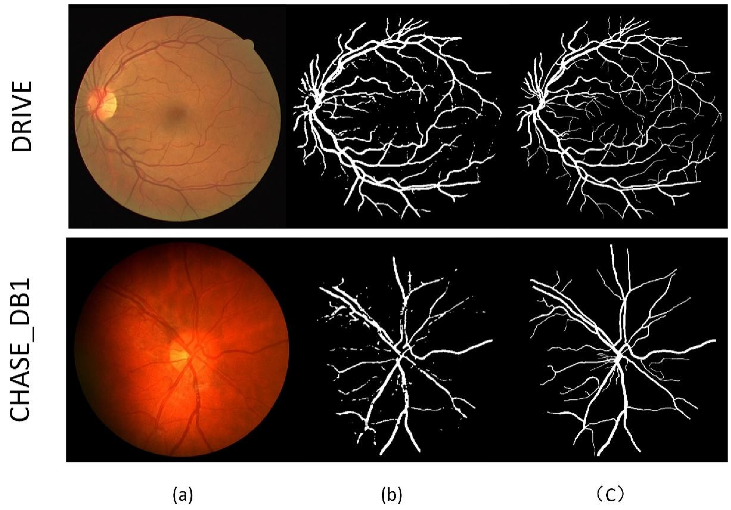 Improvement of Retinal Vessel Segmentation Method Based on U-Net