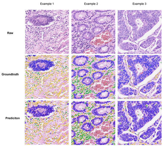 Mulvernet: Nucleus Segmentation and Classification of Pathology Images Using the HoVer-Net and ...